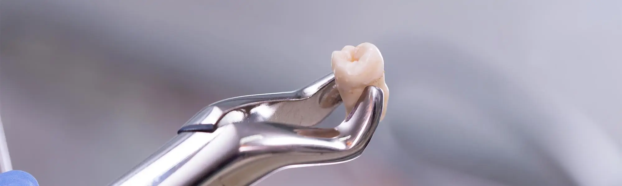 Tooth Extractions in 60640 Chicago | Call 773-506-2033
